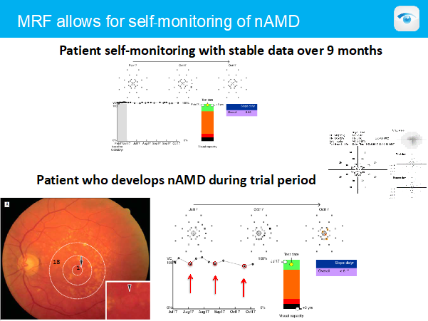 What’s the science behind the MRF visual field test? – Appview Technologies