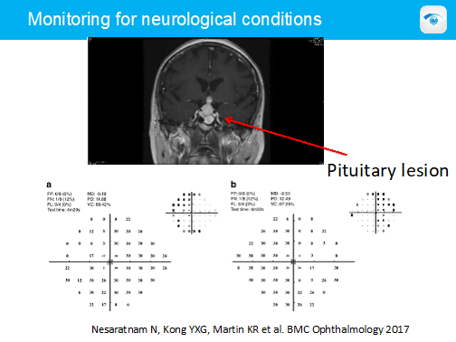 What’s the science behind the MRF visual field test? – Appview Technologies